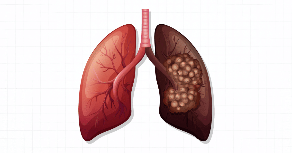 List of 57+ Facts and Statistics About Lung Cancer (2025)