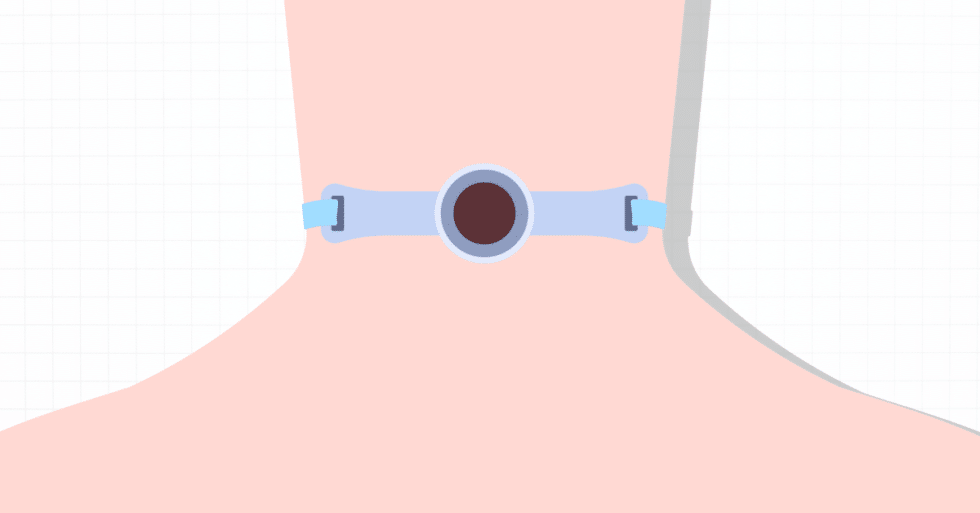 Tracheostomy: Overview and Practice Questions (2025)