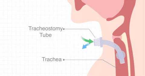 Tracheostomy: Overview and Practice Questions (2025)