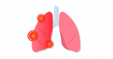 Why are My Lungs Burning? (2025)