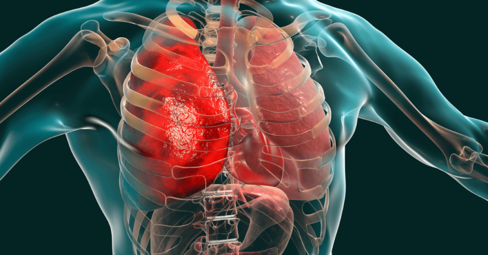 CDC Urges Pneumococcal Vaccine for Adults Ages 50 to 64