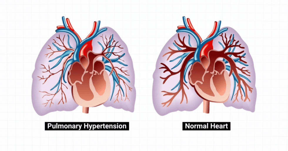 11 Natural Ways To Reverse Pulmonary Hypertension 2025
