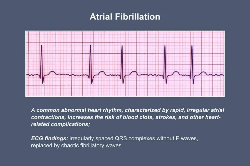 EKG Interpretation: Overview and Practice Questions (2026)