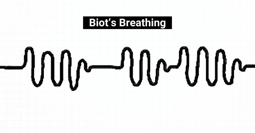 Biot's Breathing Pattern: An Overview (2024)