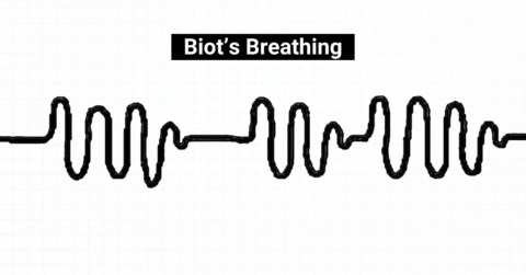 Biot's Breathing Pattern: An Overview (2025)