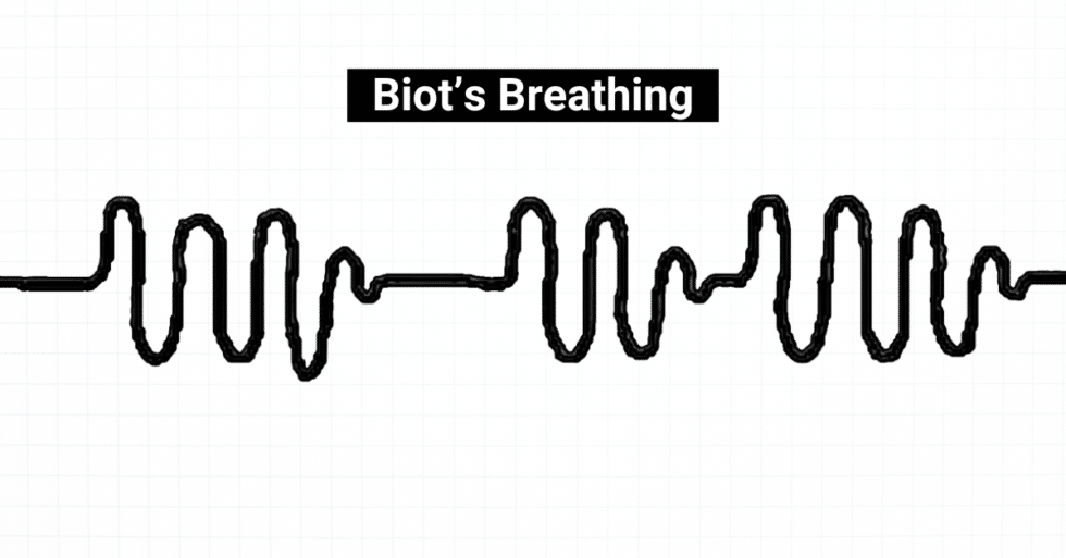 Biot's Breathing Pattern: An Overview (2026)