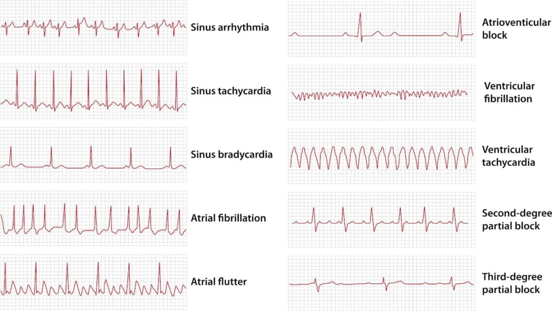 EKG Interpretation: Overview and Practice Questions (2024)