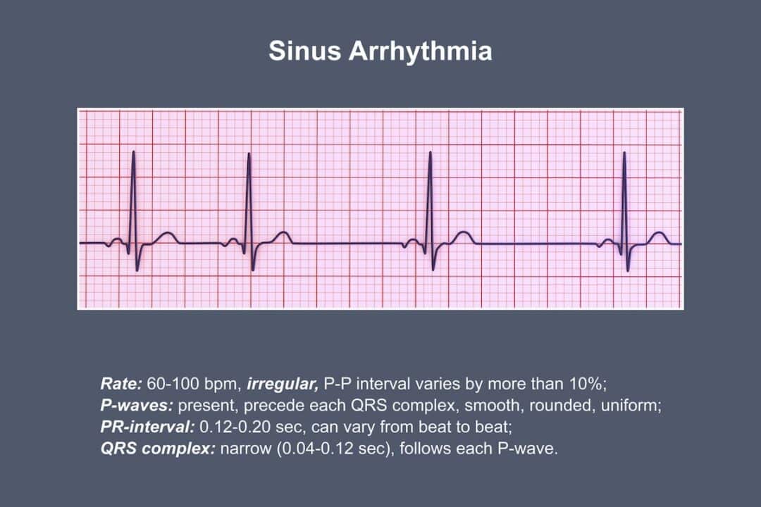 EKG Interpretation: Overview and Practice Questions (2024)