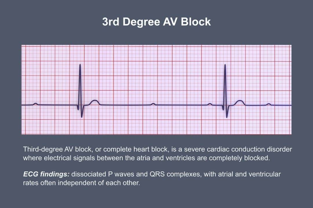 EKG Interpretation: Overview and Practice Questions (2024)