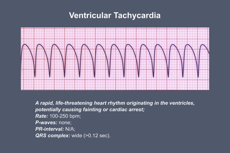 EKG Interpretation: Overview and Practice Questions (2024)