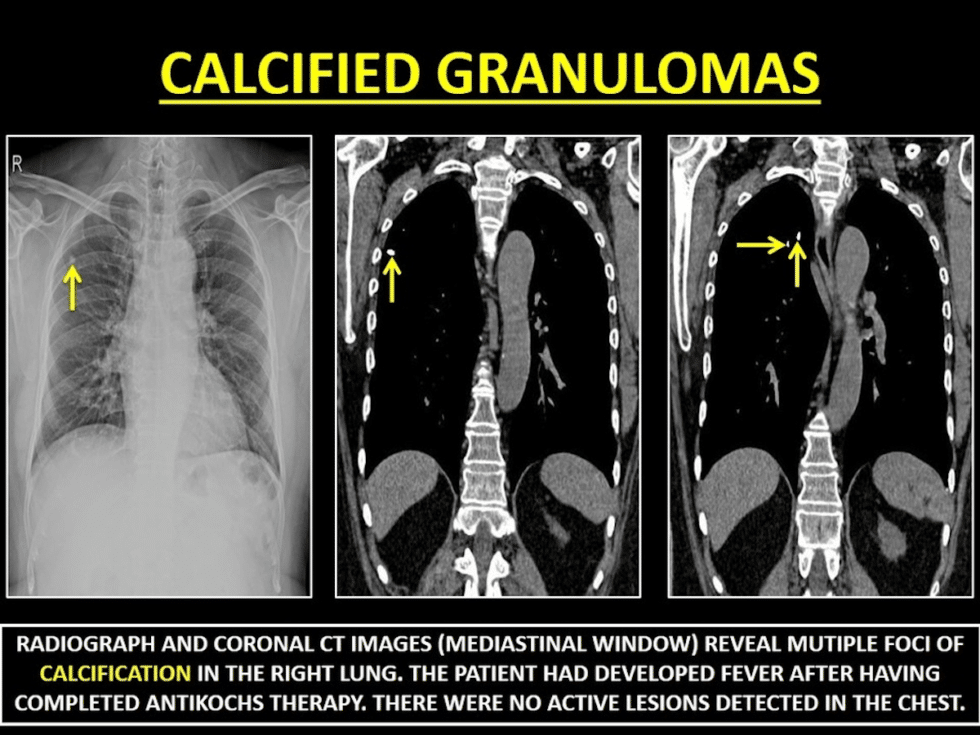 What is a Calcified Granuloma in the Lungs? (2025)