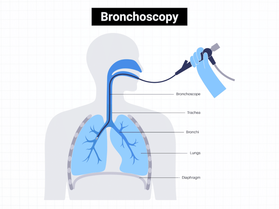 Bronchoscopy: Overview and Practice Questions (2025)