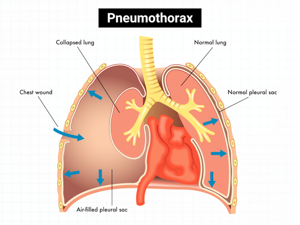 Pneumothorax: Clinical Signs and TMC/CSE Exam Tips (2025)