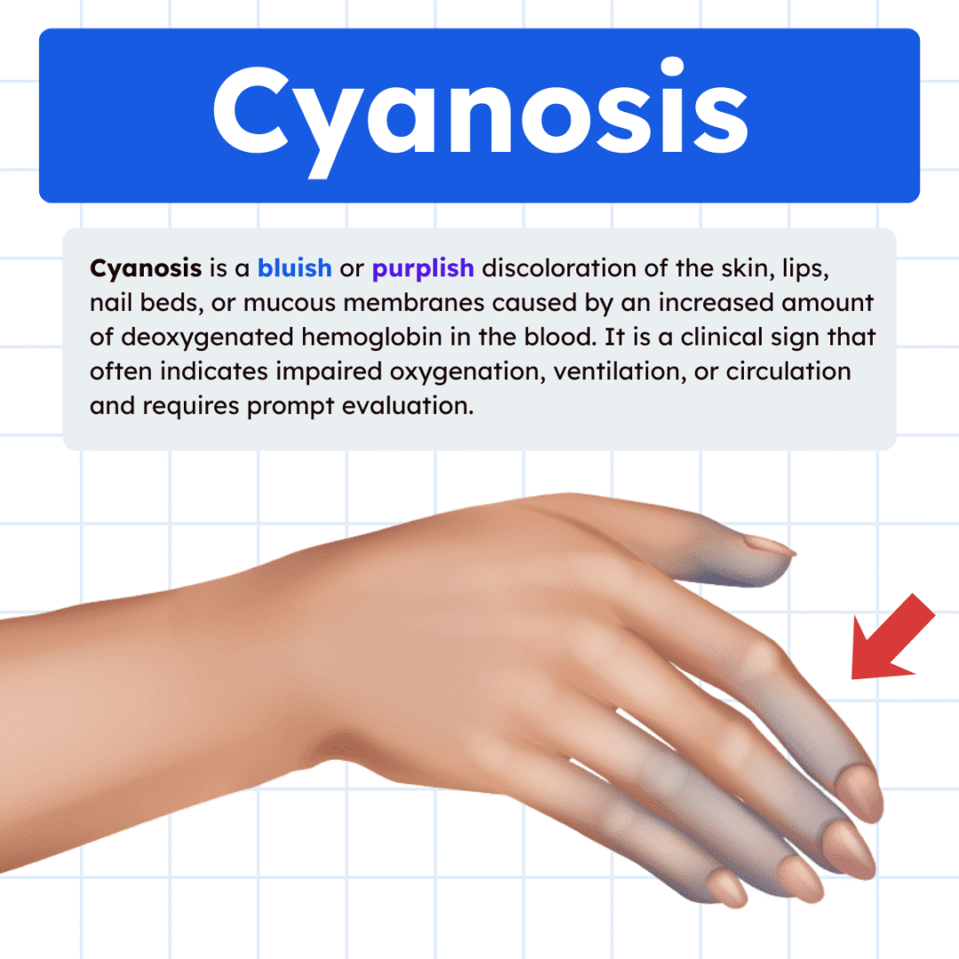Cyanosis: Overview and Practice Questions (2026)