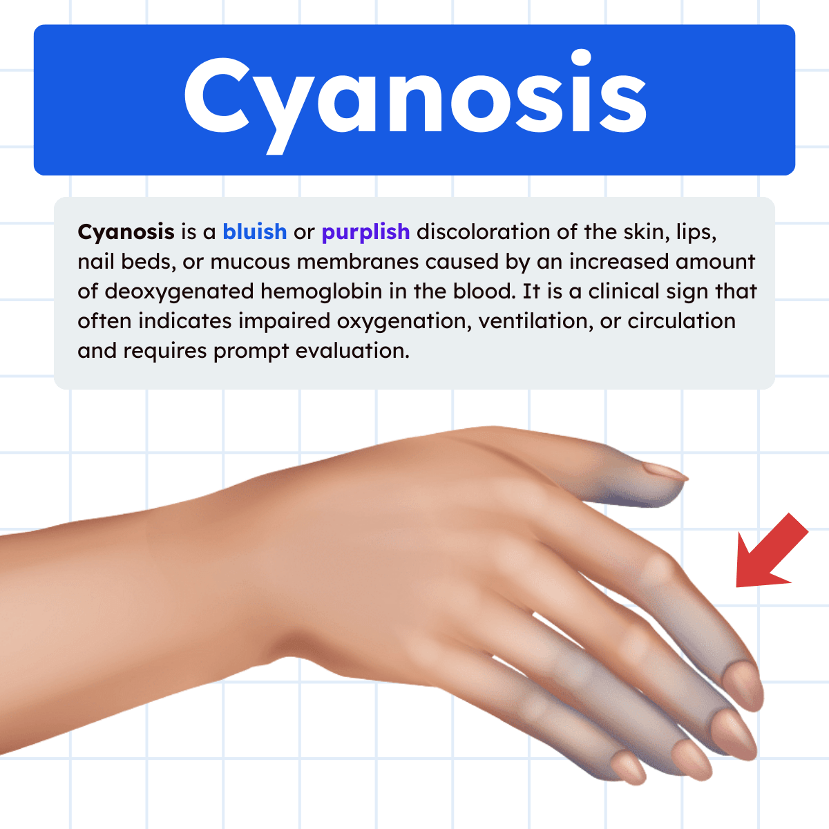Cyanosis: Overview and Practice Questions (2026)