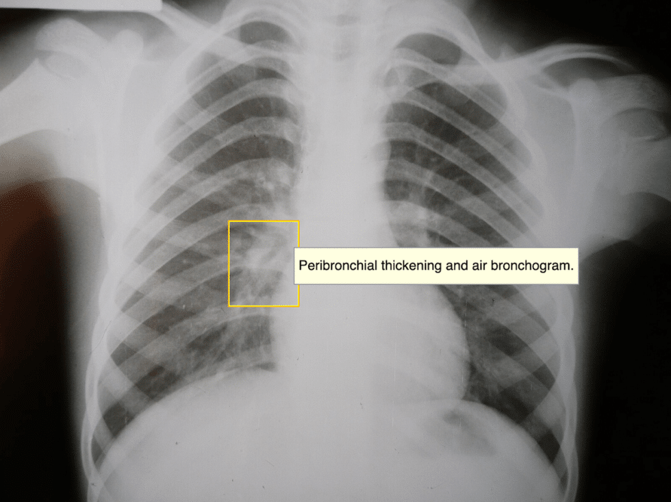 Air Bronchogram: Key Imaging Sign of Lung Disease (2026)