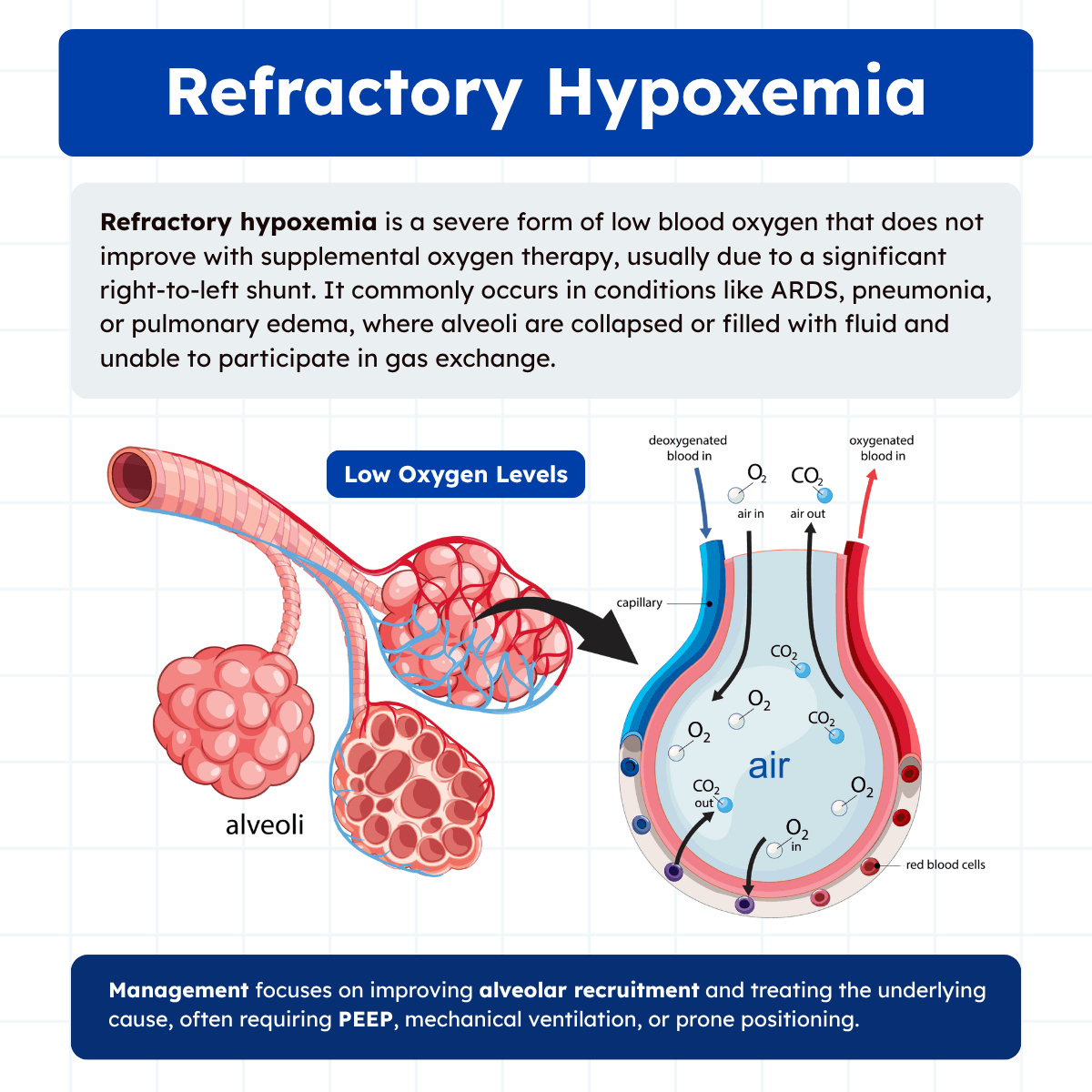 Refractory Hypoxemia: Causes and Clinical Management (2026)