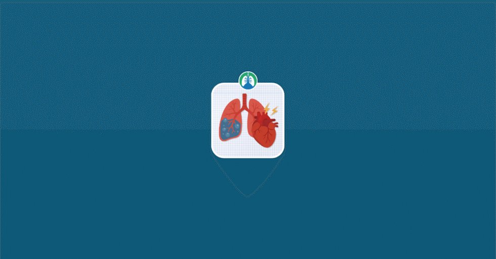 Can Pulmonary Edema Cause Sudden Death? (2025)