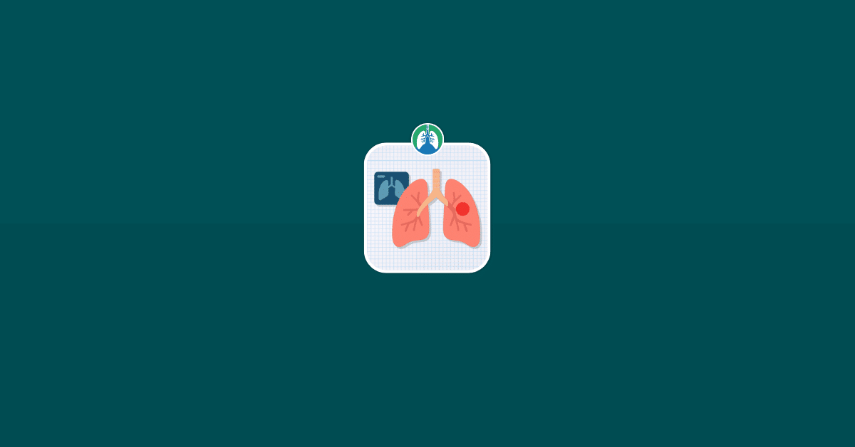 Lung Nodule: Types, Causes, Symptoms, and Treatment (2025)