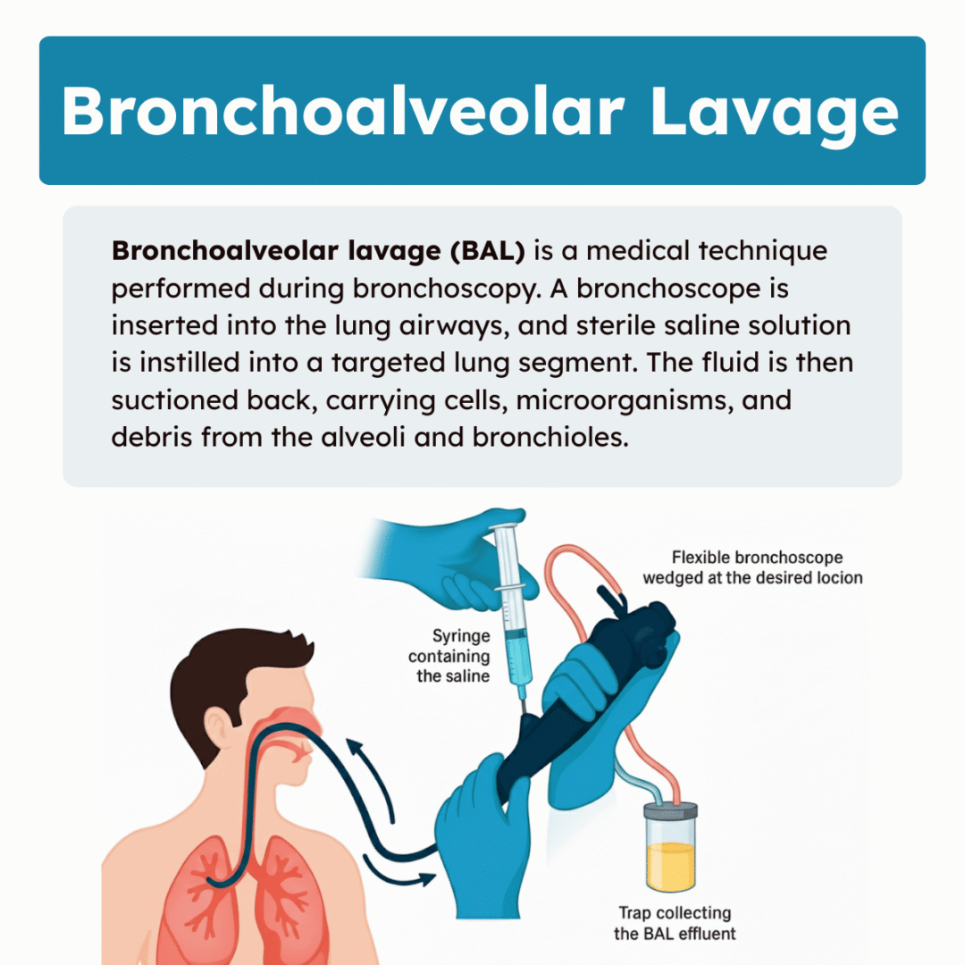 Bronchoalveolar Lavage: Overview and Practice Questions