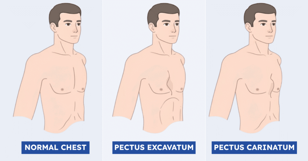 Pectus Excavatum vs. Pectus Carinatum: An Overview (2025)