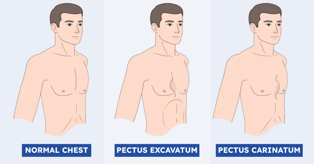 Pectus Excavatum Vs Pectus Carinatum An Overview 2026 