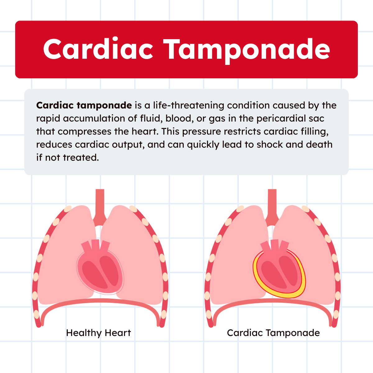 Cardiac Tamponade: Overview and Practice Questions (2026)