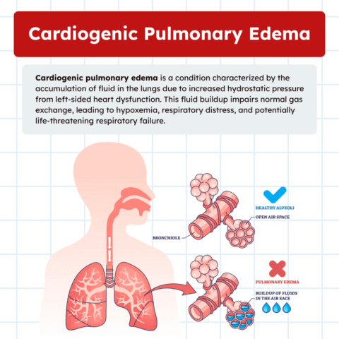 Cardiogenic Pulmonary Edema: Diagnosis and Management
