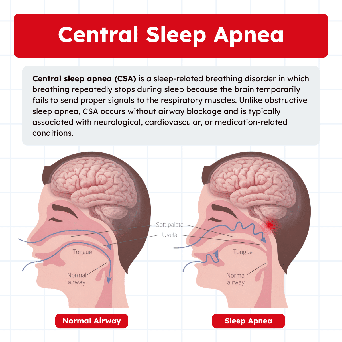 Central Sleep Apnea Overview And Practice Questions 2026