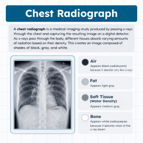 Chest Radiograph (X-Ray): Overview and Practice Questions