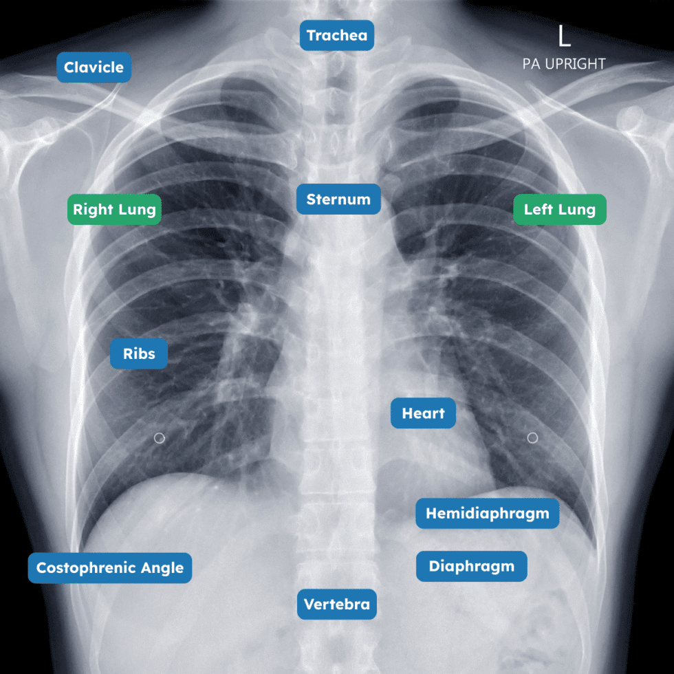 Chest Radiograph (X-Ray): Overview and Practice Questions