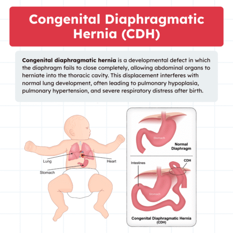 Congenital Diaphragmatic Hernia (CDH): An Overview (2026)