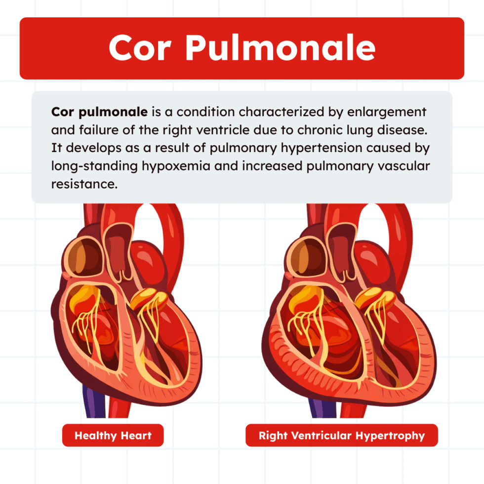 Cor Pulmonale in COPD and Chronic Lung Disease (2026)