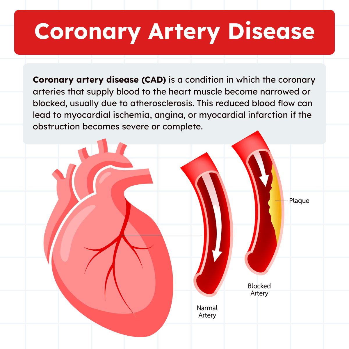 Coronary Artery Disease (CAD) in Respiratory Care (2026)
