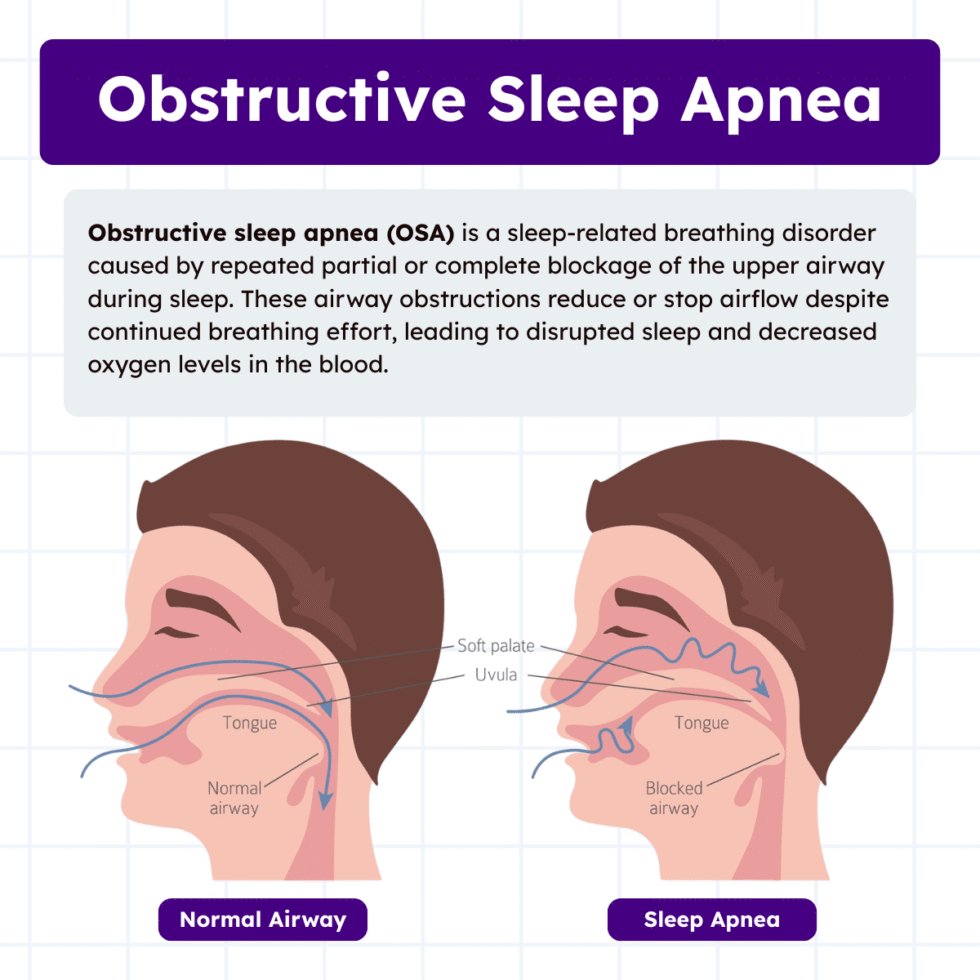 Obstructive Sleep Apnea: Overview and Practice Questions