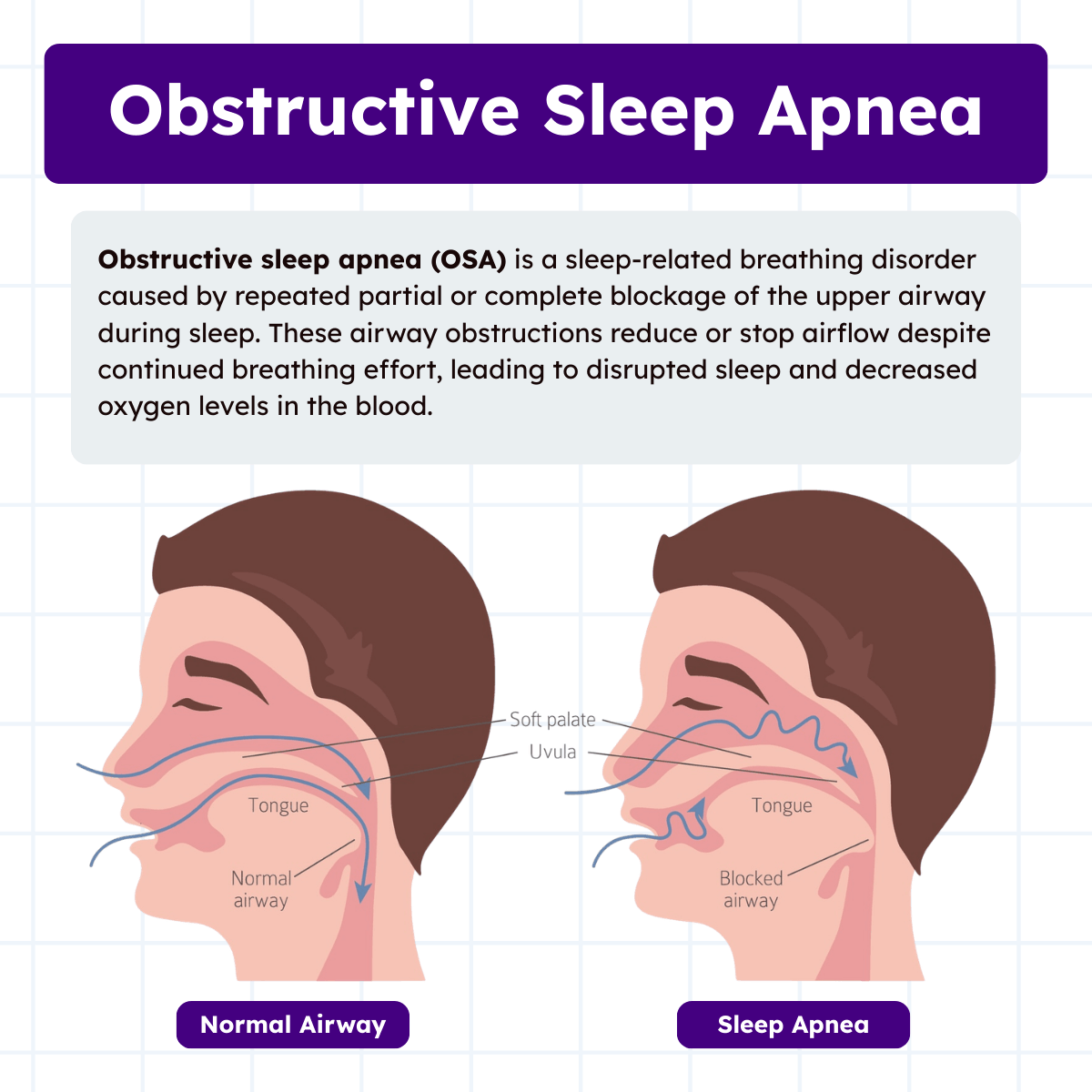 Obstructive Sleep Apnea: Overview and Practice Questions