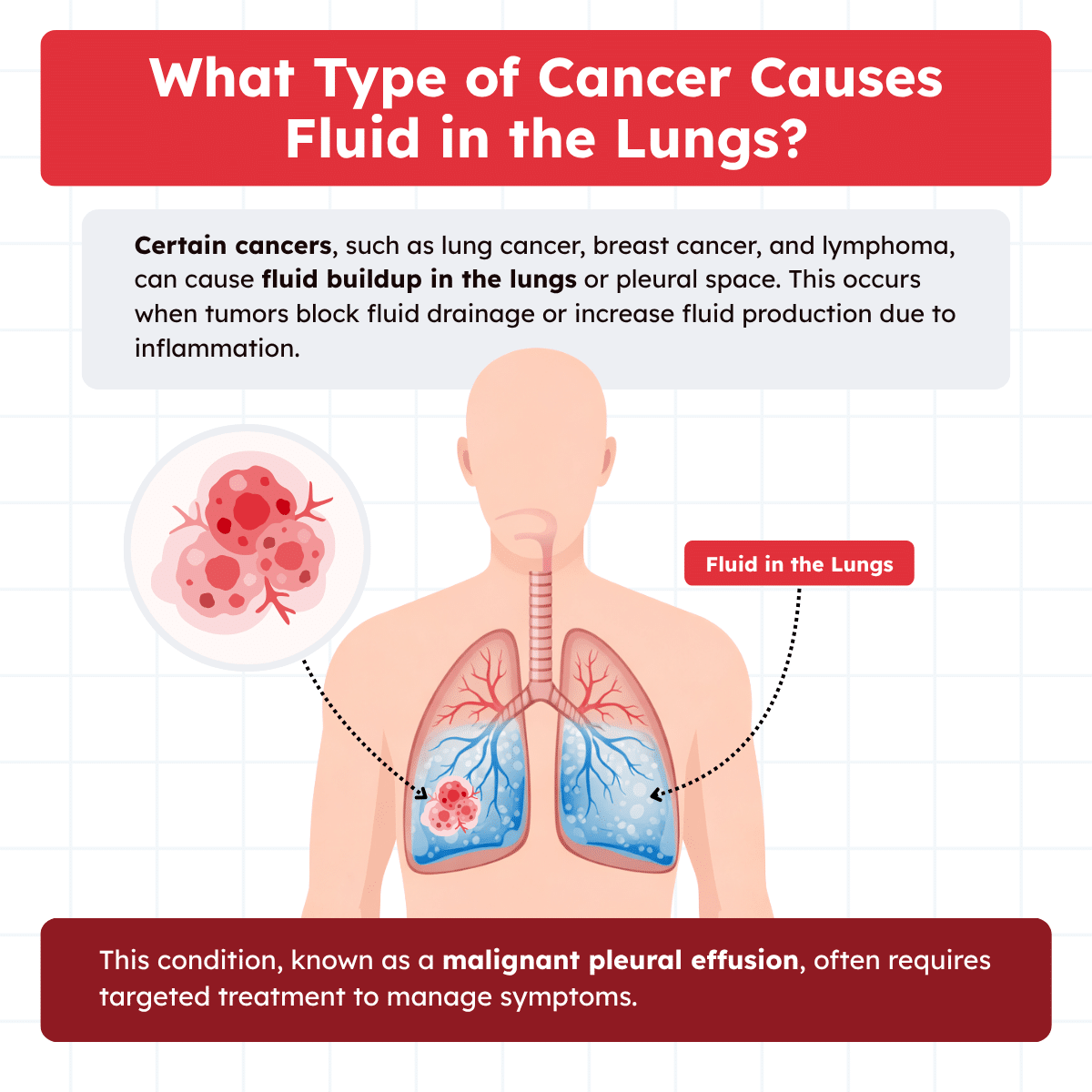 What Type of Cancer Causes Fluid in the Lungs? (2026)