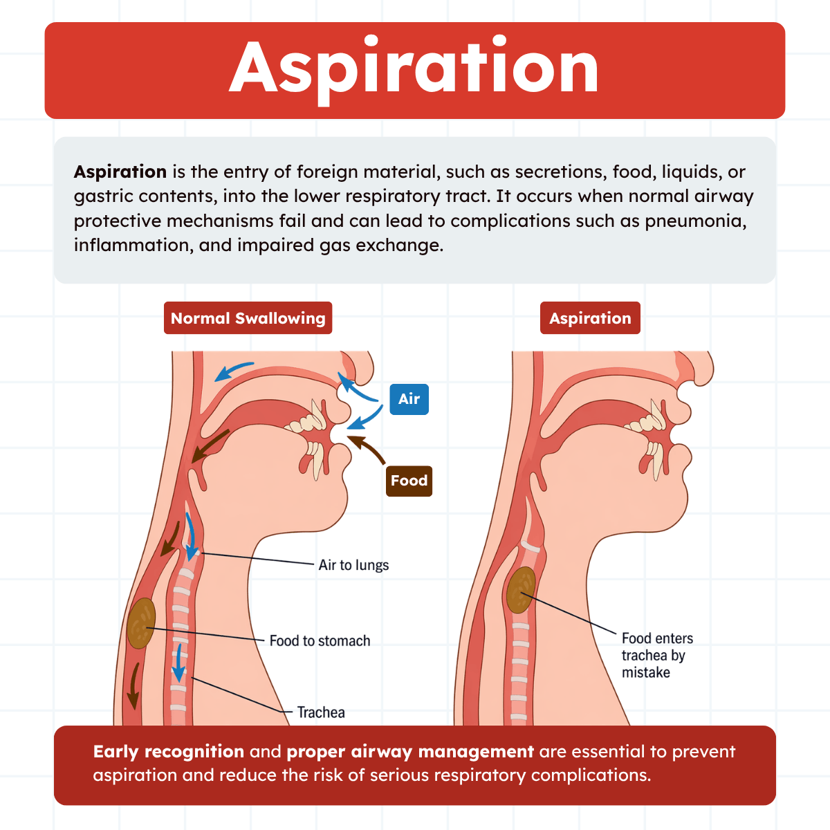 Aspiration in Respiratory Care: Causes and Prevention (2026)