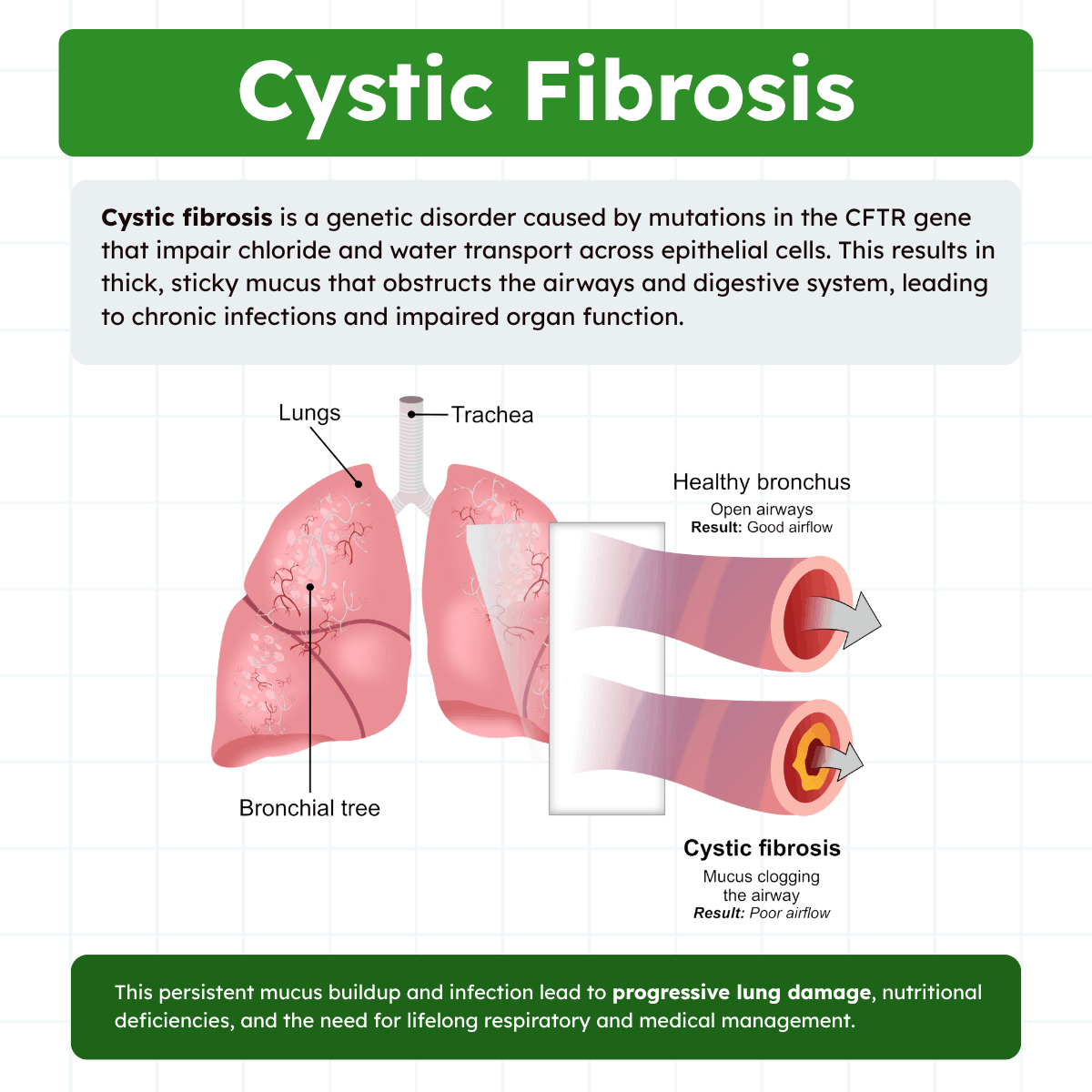Cystic Fibrosis: Pathophysiology and Clinical Overview